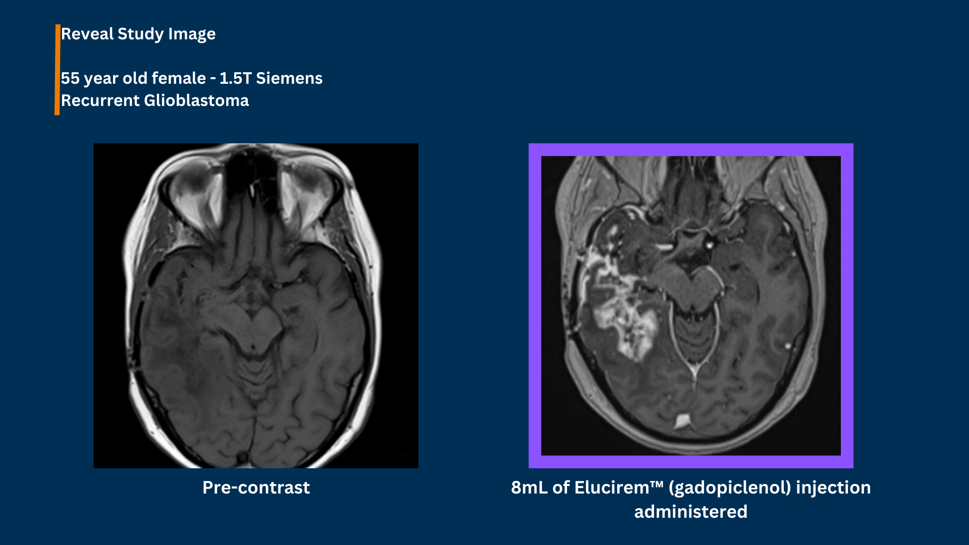 Guerbet - Elucerim (gadopiclenol) injection Image Reveal Challenge