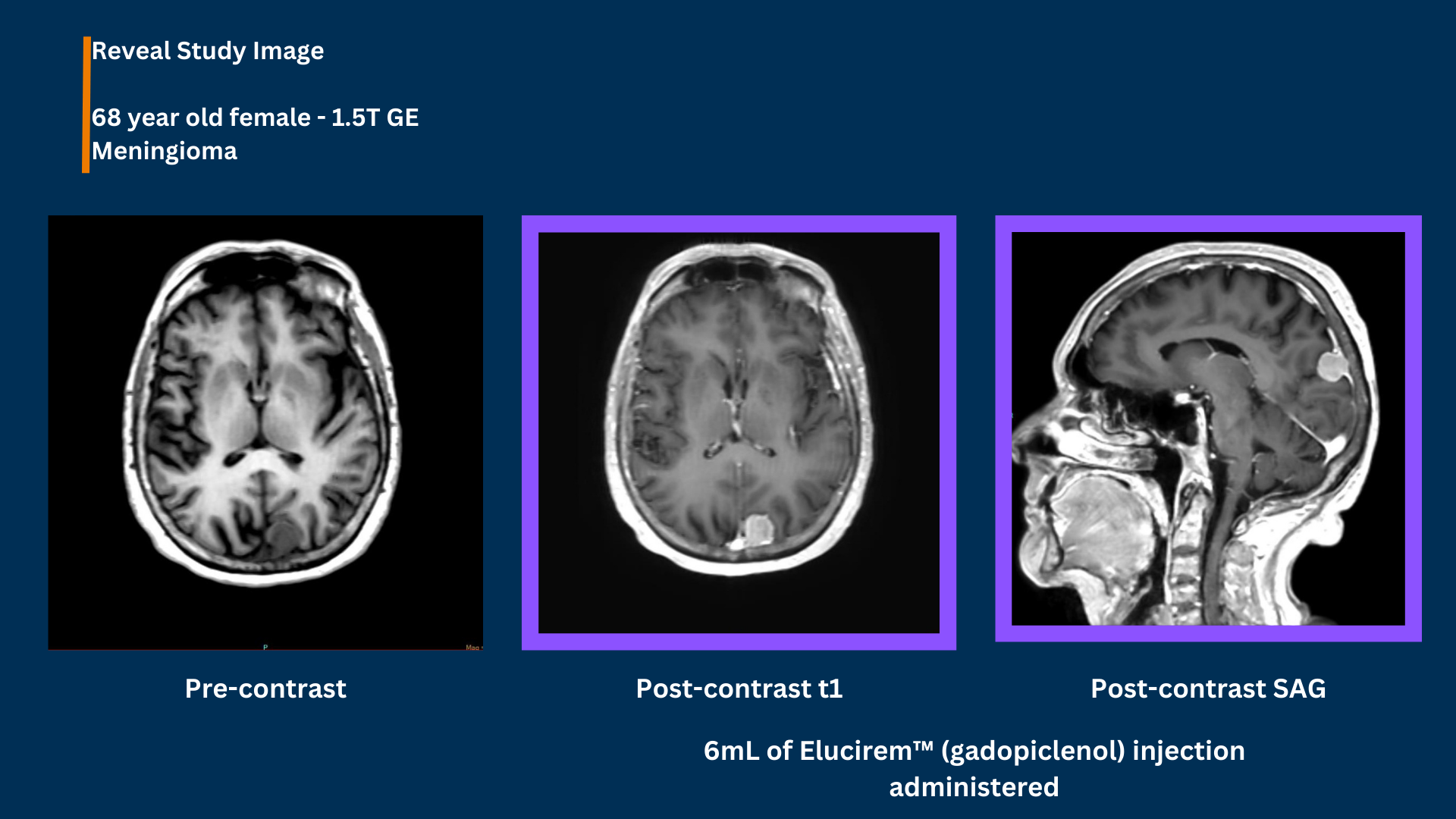 Guerbet - Elucerim (gadopiclenol) injection Image Reveal Challenge