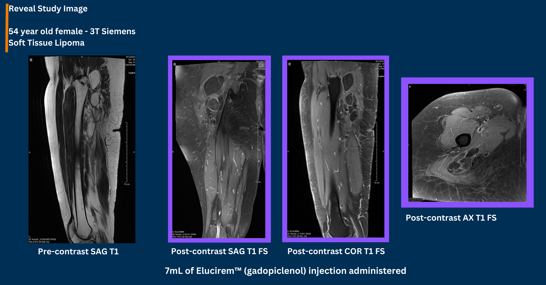 Guerbet - Elucerim (gadopiclenol) injection Image Reveal Challenge